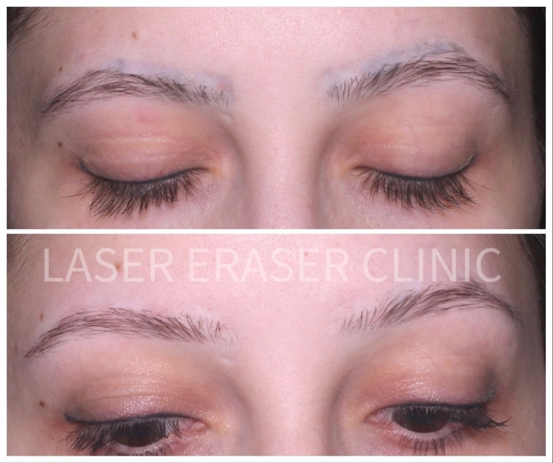 Te-ai gandit la tratament laser tatuaje? Vino la Laser Eraser! - Laser ...